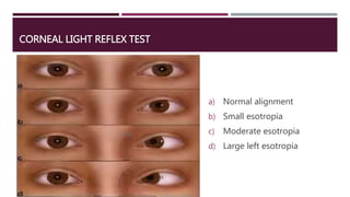 Pediatric Eye Examination | PPTX