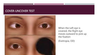 Pediatric Cover Test