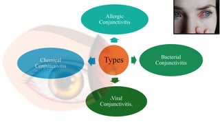 Conjunctivitis eye flu..pptx