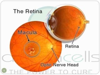 Eyeing macular degeneration with stem cells- Advancells | PPTX