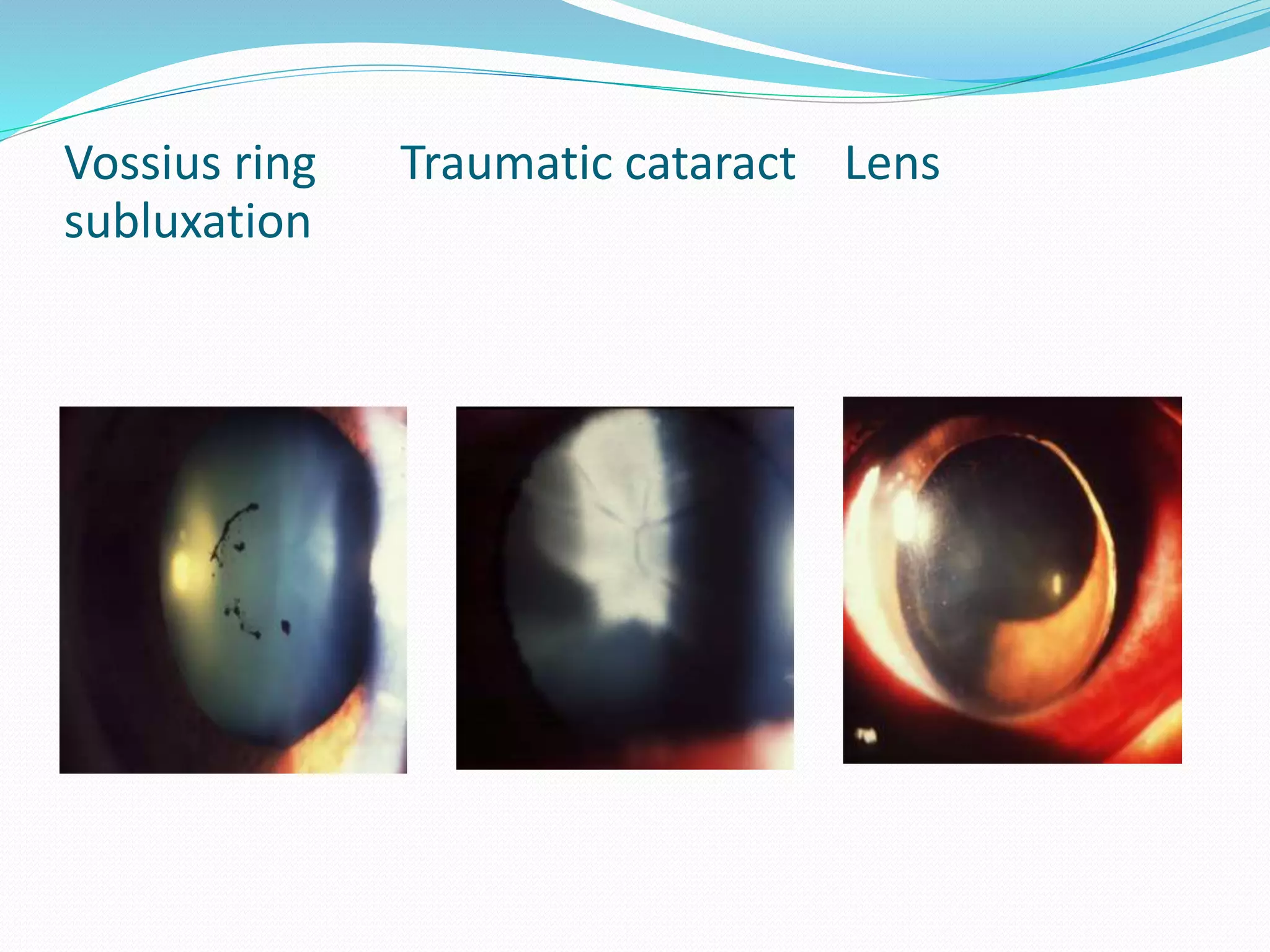 Eye injuries | PPTX