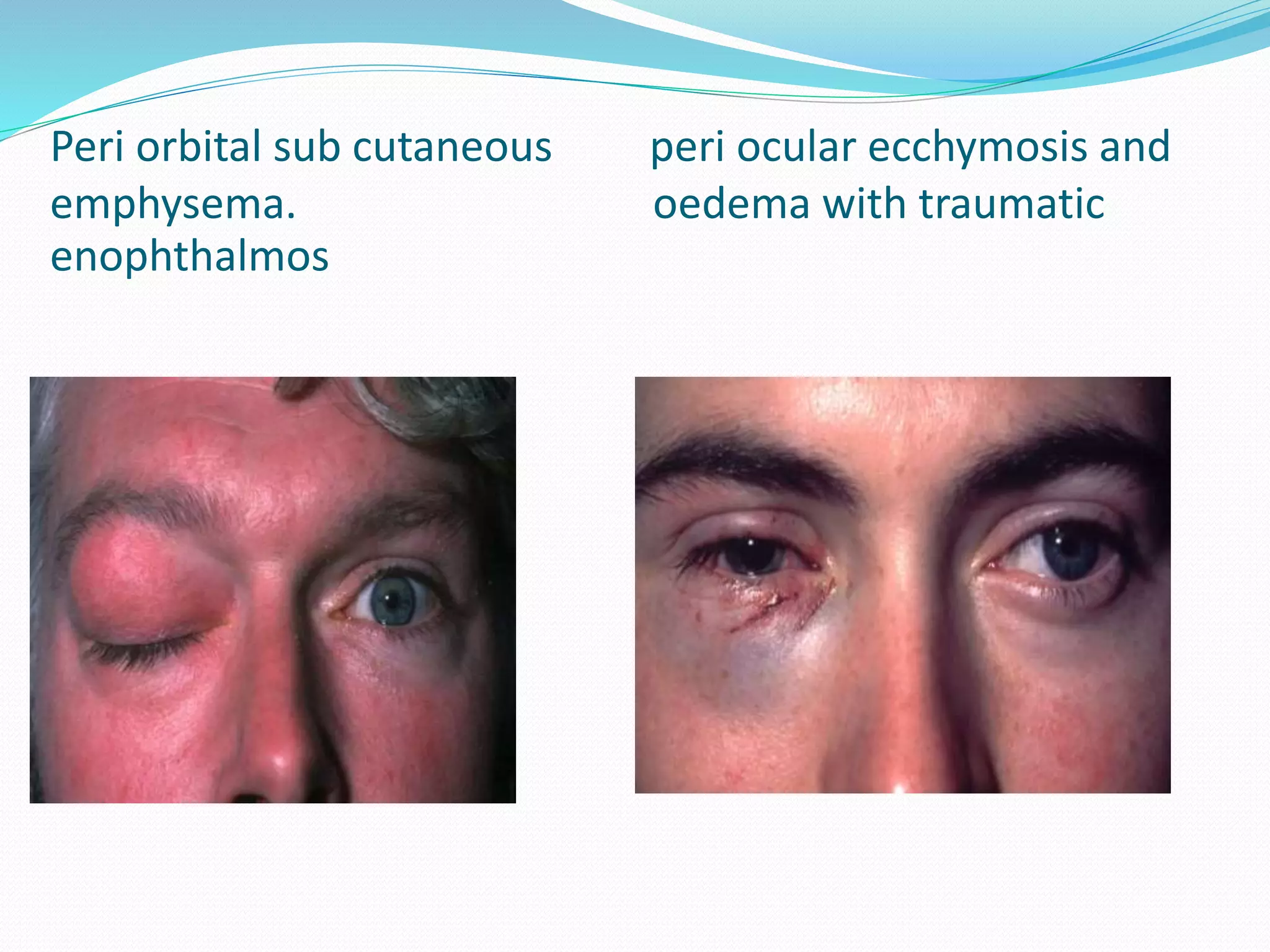 Eye injuries | PPTX