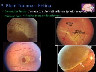 Eye injuries.pdfhhhhhhhhhhhhhhhhhhhhhhhh | PPT