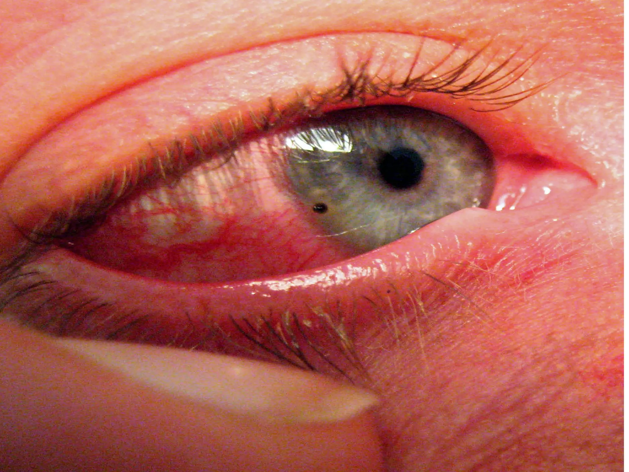 Eye injury.pptxaaaaaaaaaaaaaaaaaaaaaaaaaa | PPT