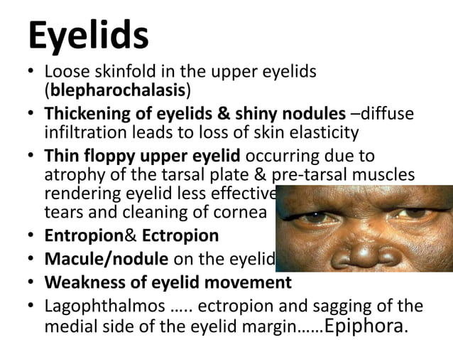 Eye in leprosy | PPTX
