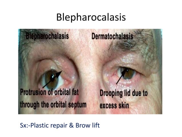 Eye in leprosy | PPTX