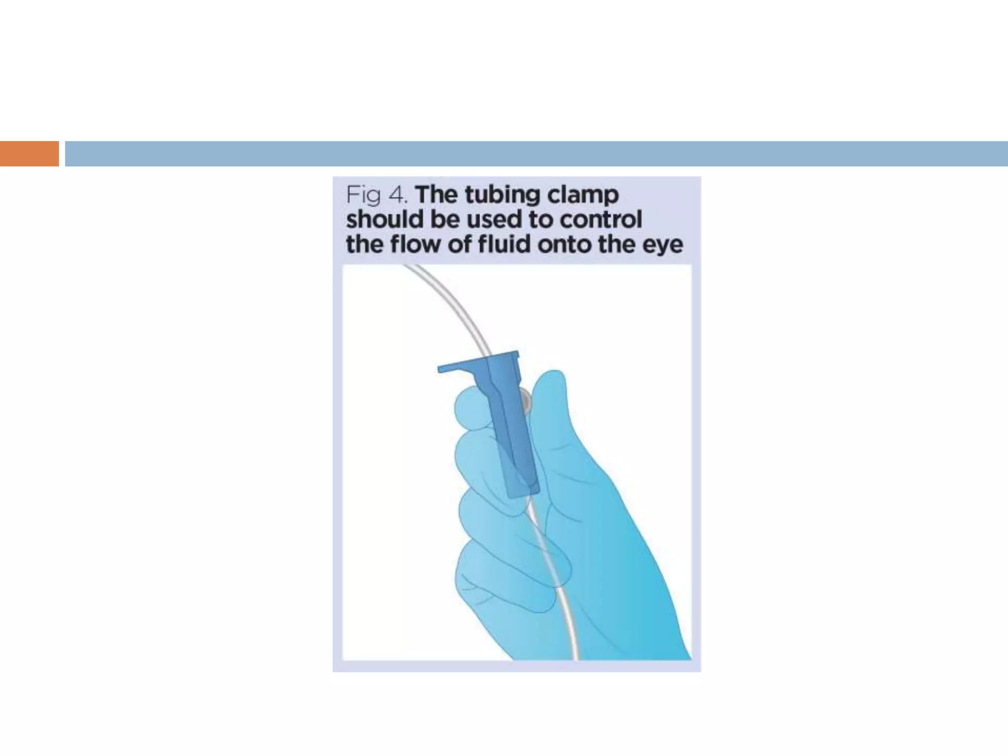 Eye irrigation | PPTX