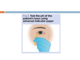 Eye irrigation | PPTX
