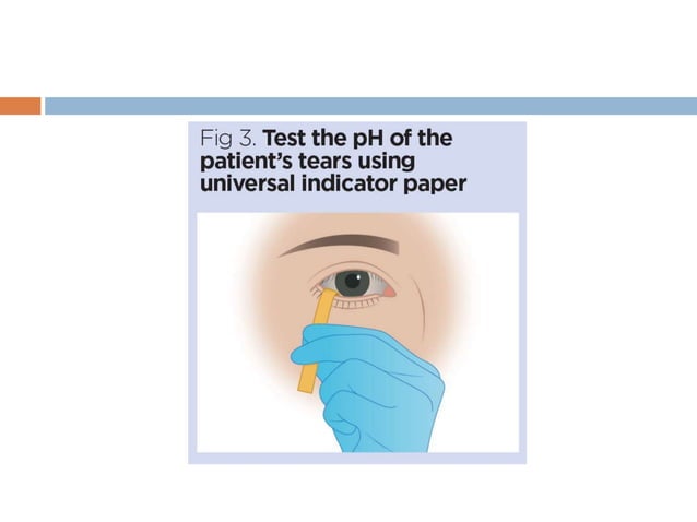 Eye irrigation | PPTX