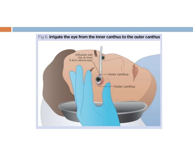 Eye irrigation | PPTX