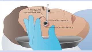 EYE IRRIGATION .pptx