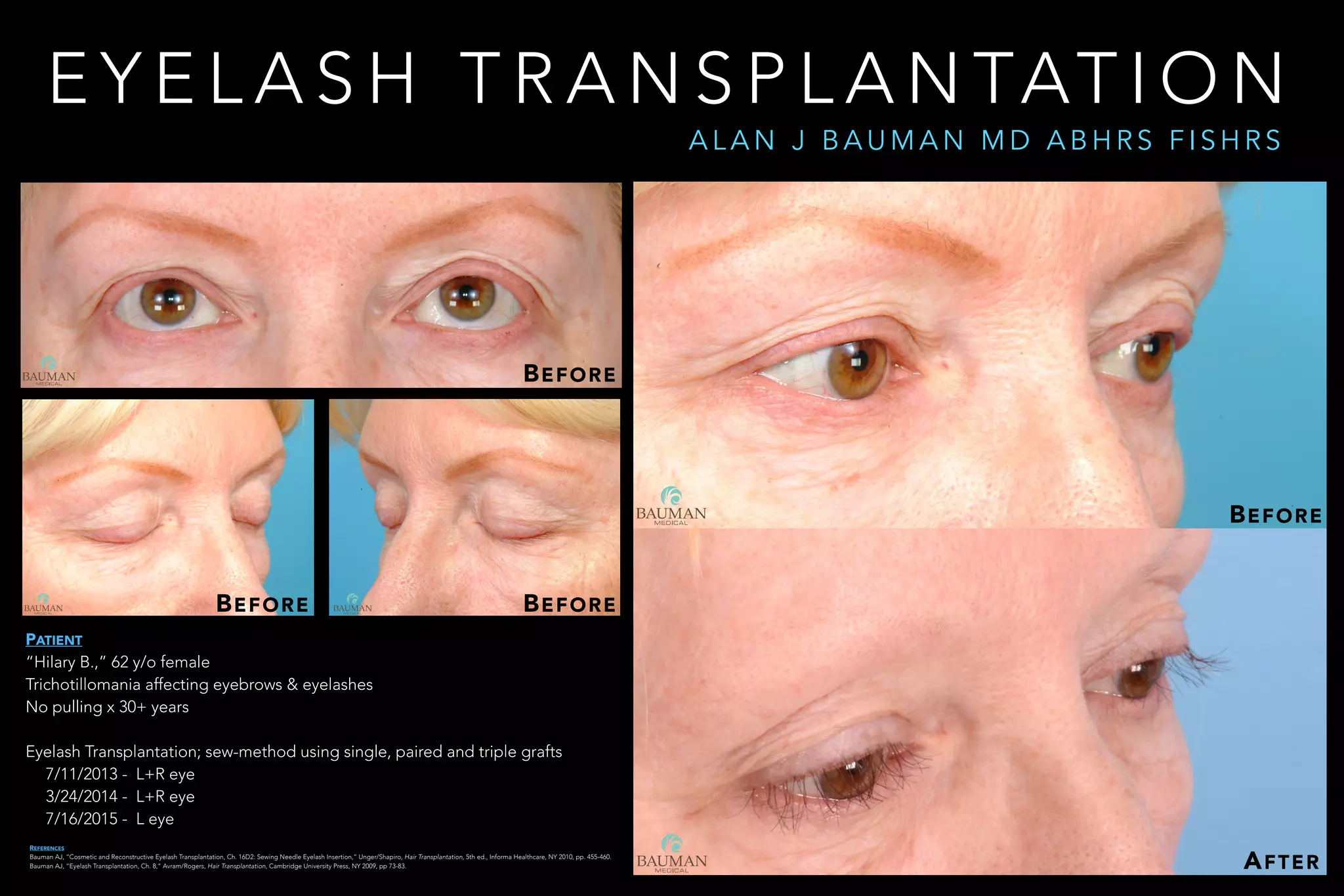 Eyelash transplant live-patient-viewing_ISHRS-2015 - Dr Alan Bauman | PDF