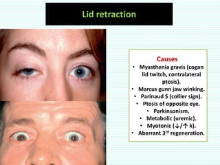 Colliers Sign Eyelid Retraction