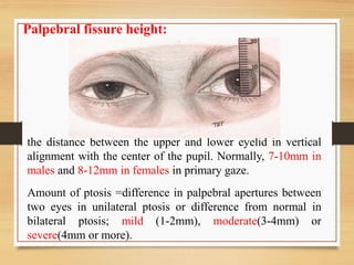 eye lid abnormalities in ophthalmology.pdf