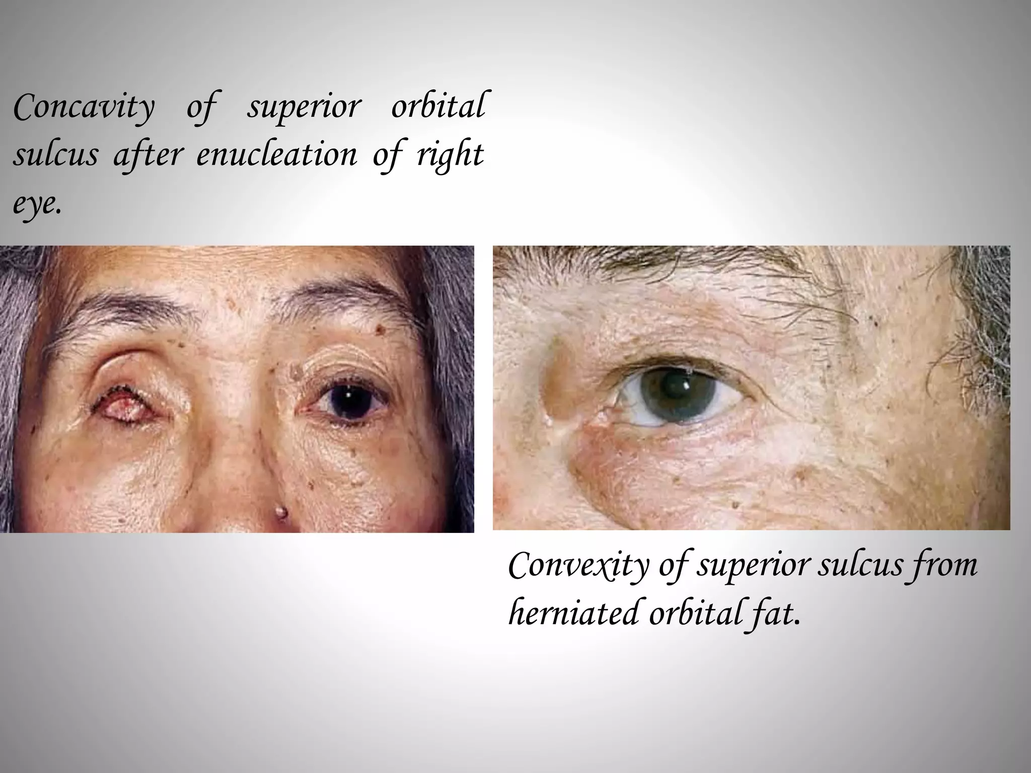 Eye lid anatomy | PPTX