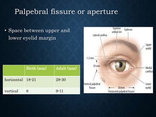 Palpebral Fissure Diagram