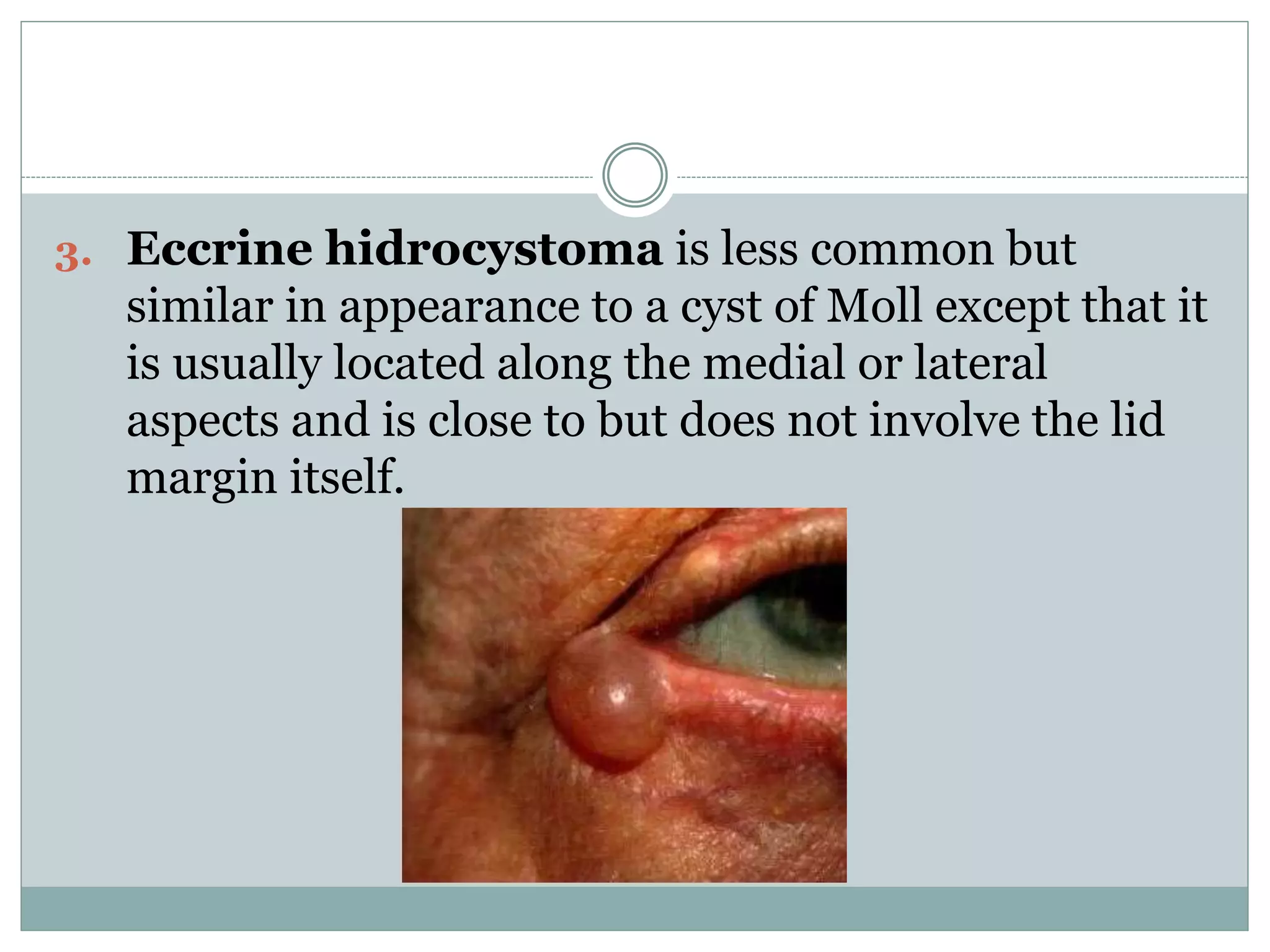 Eyelid cysts | PPTX