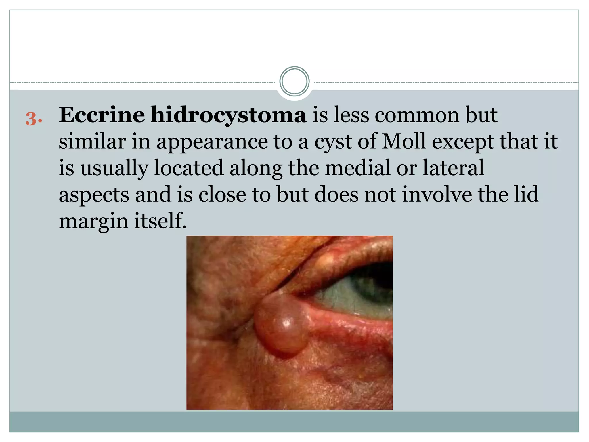 Eyelid cysts converted | PPTX