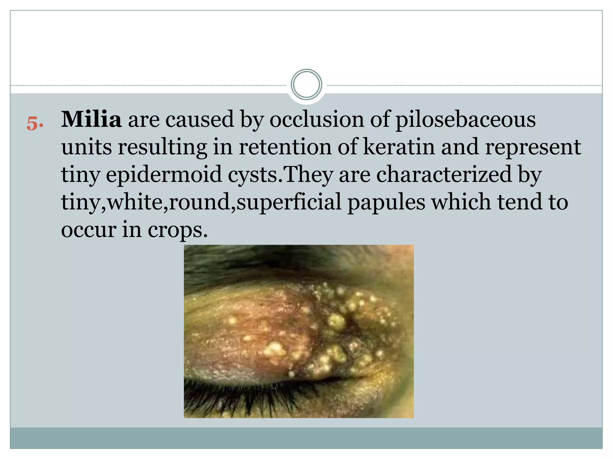 Eyelid cysts converted | PPTX