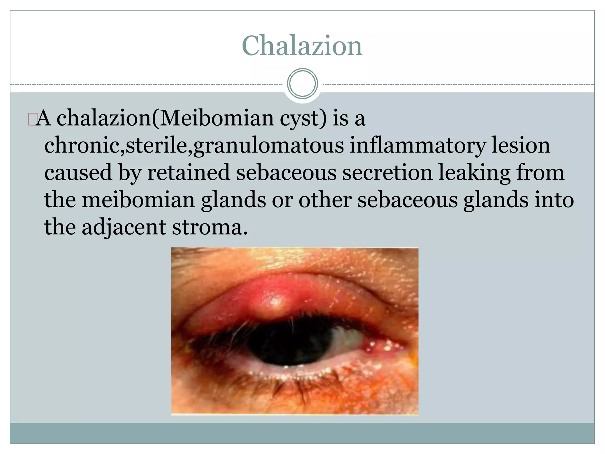 Eyelid cysts converted | PPTX