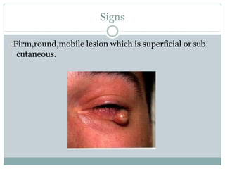 Eyelid cysts converted | PPTX