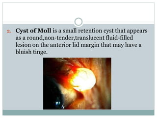 Eyelid cysts converted | PPT