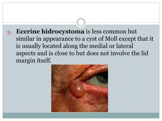 Eyelid cysts converted | PPTX