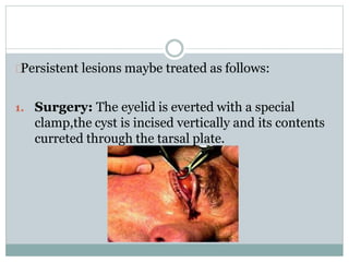 Eyelid cysts converted | PPT