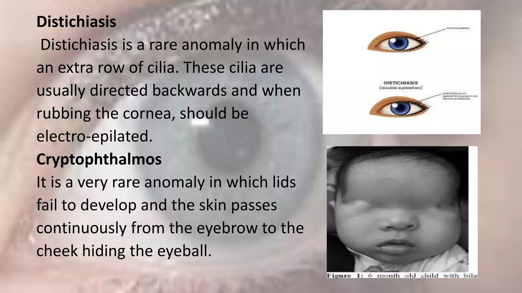 Diseases of eyelid.pptx