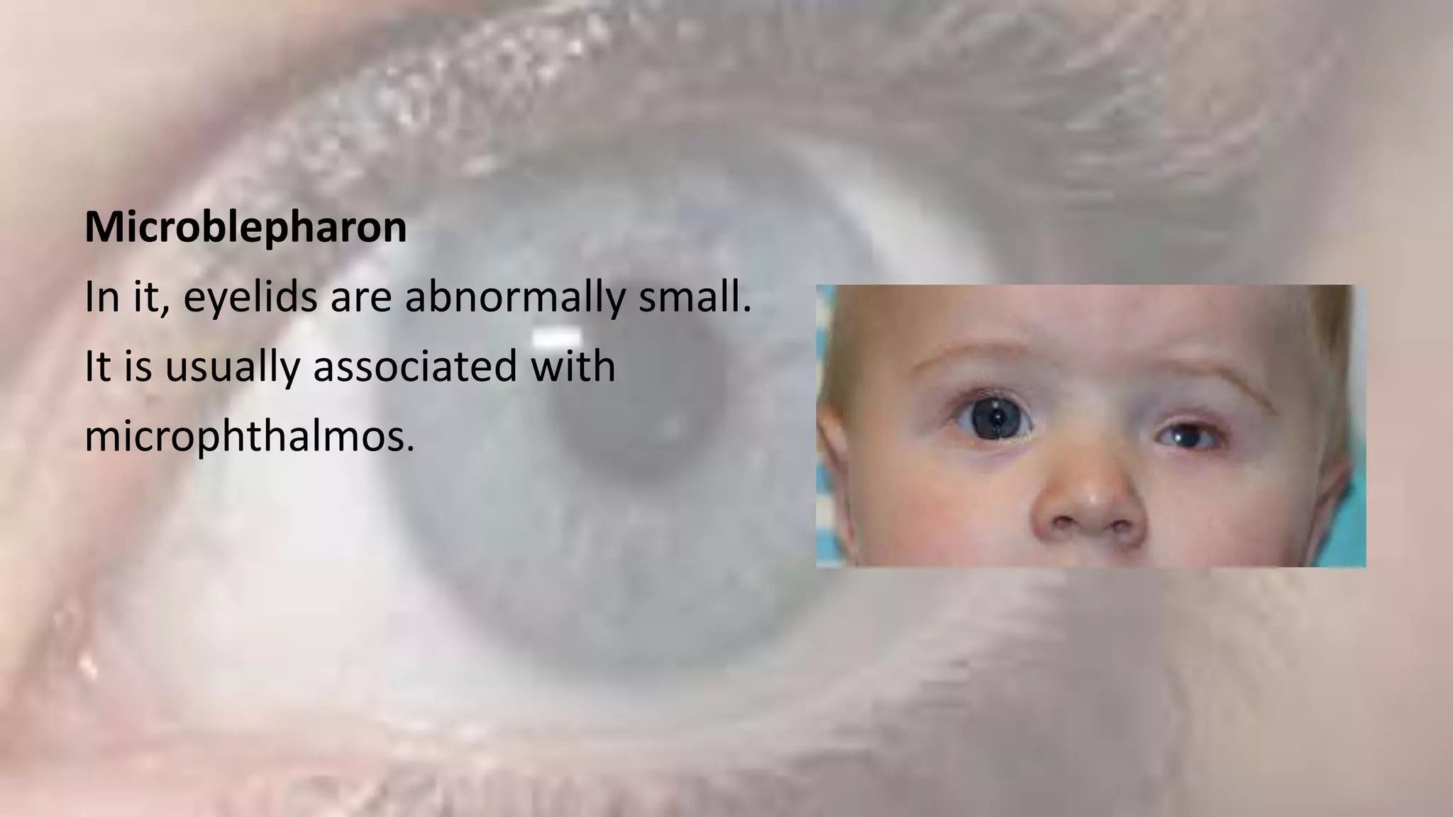 Diseases of eyelid.pptx