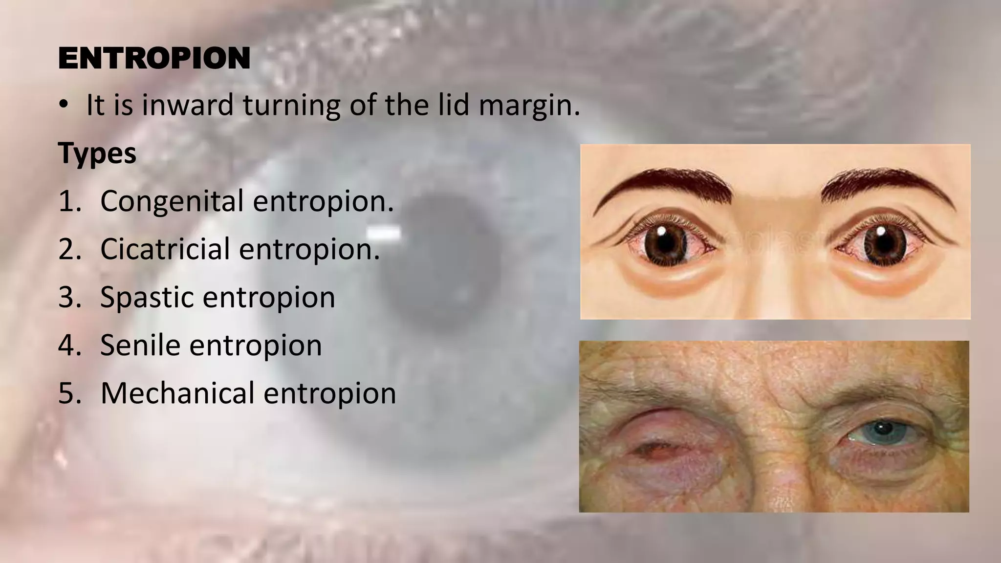 Diseases of eyelid.pptx