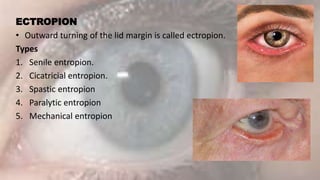 Diseases of eyelid.pptx