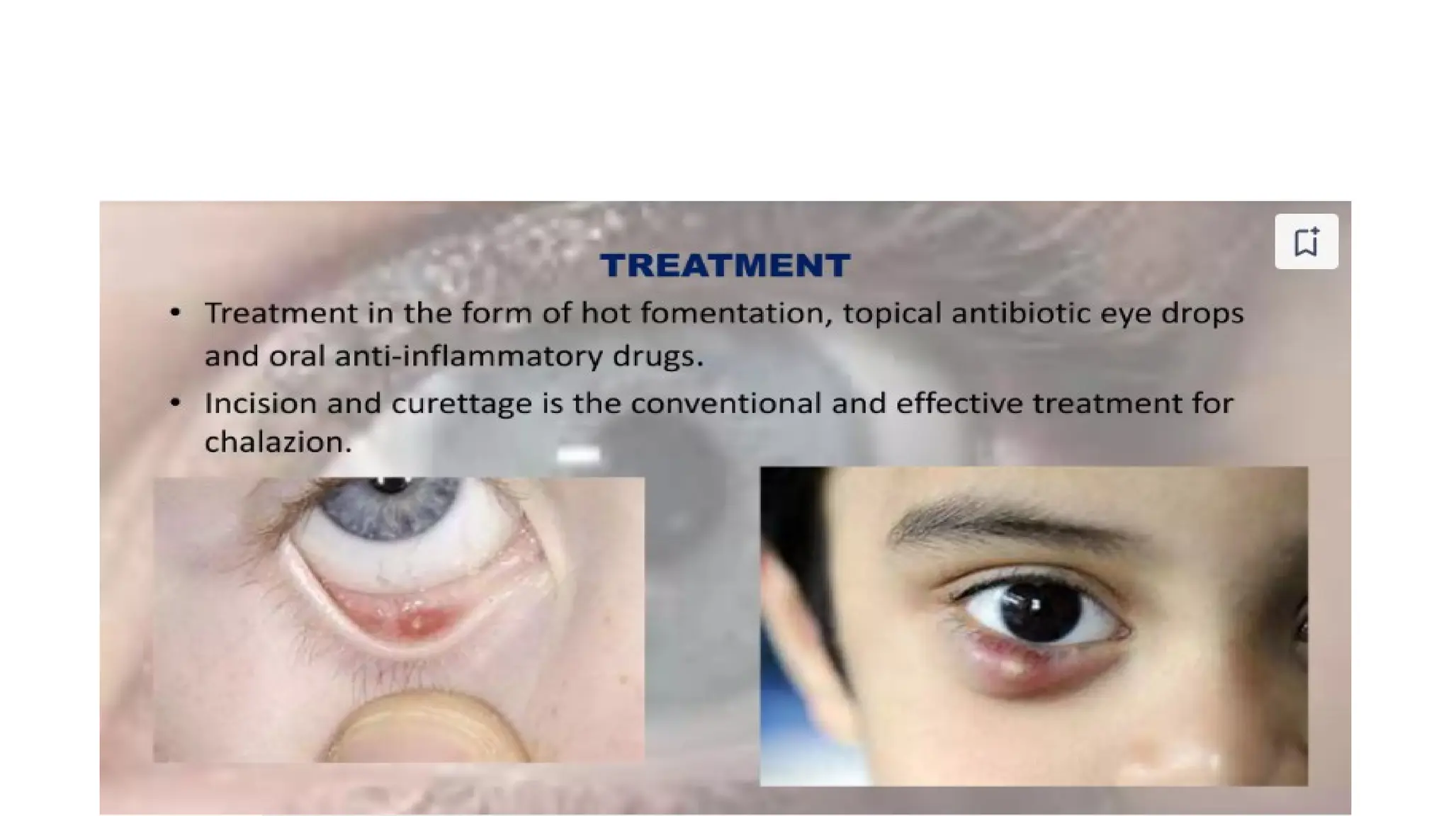 EYELID DISEASES in ophthalmology medicine .pptx
