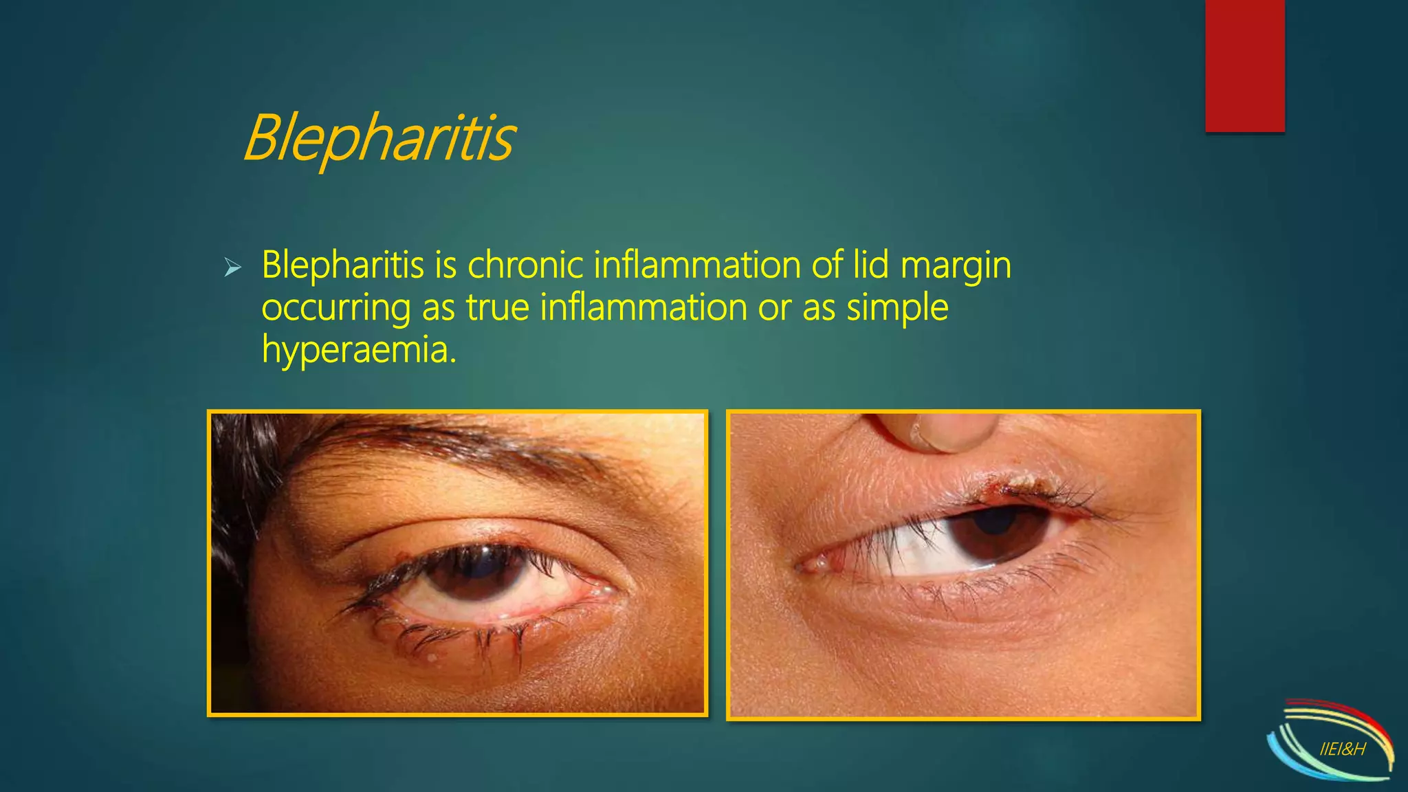 Disorders of eyelids | PPTX