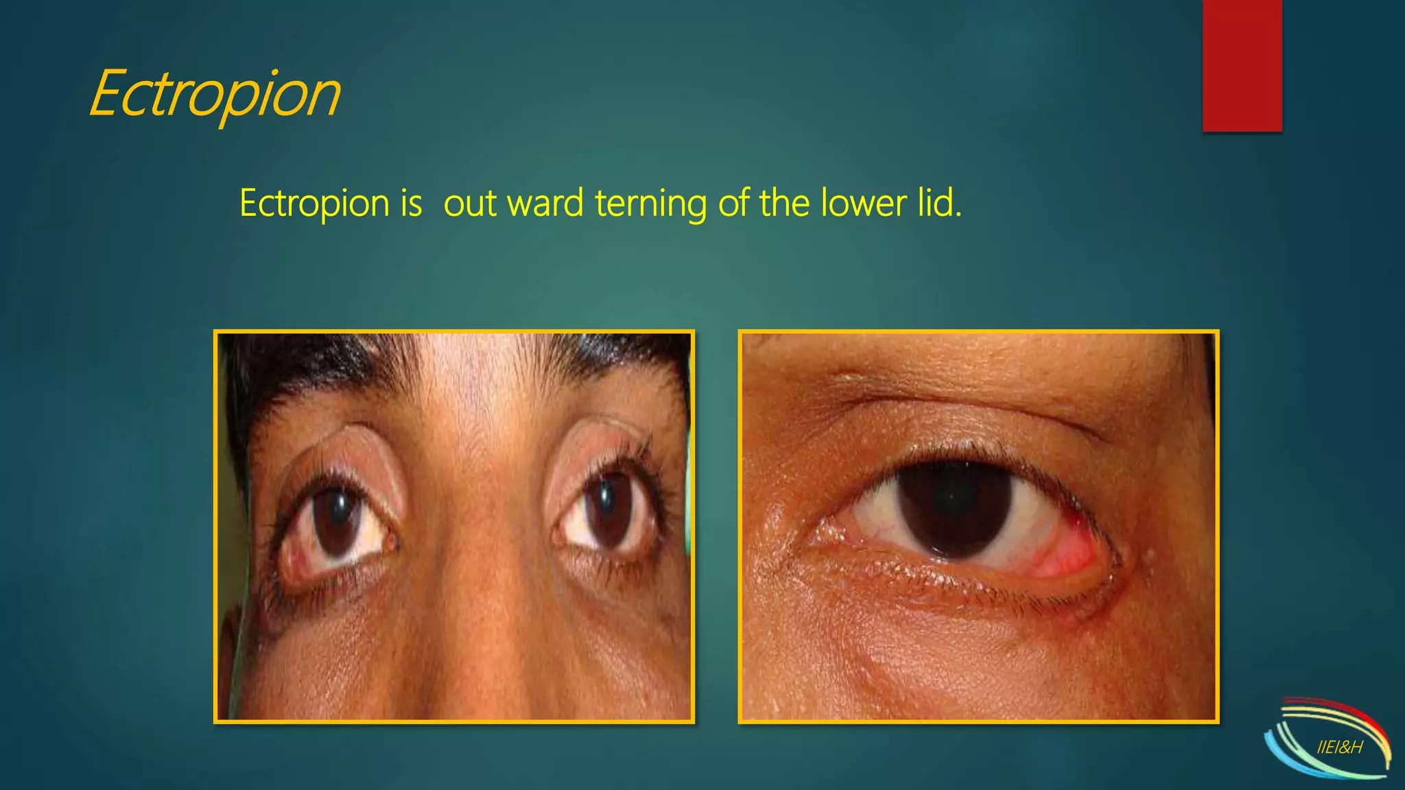Disorders of eyelids | PPTX