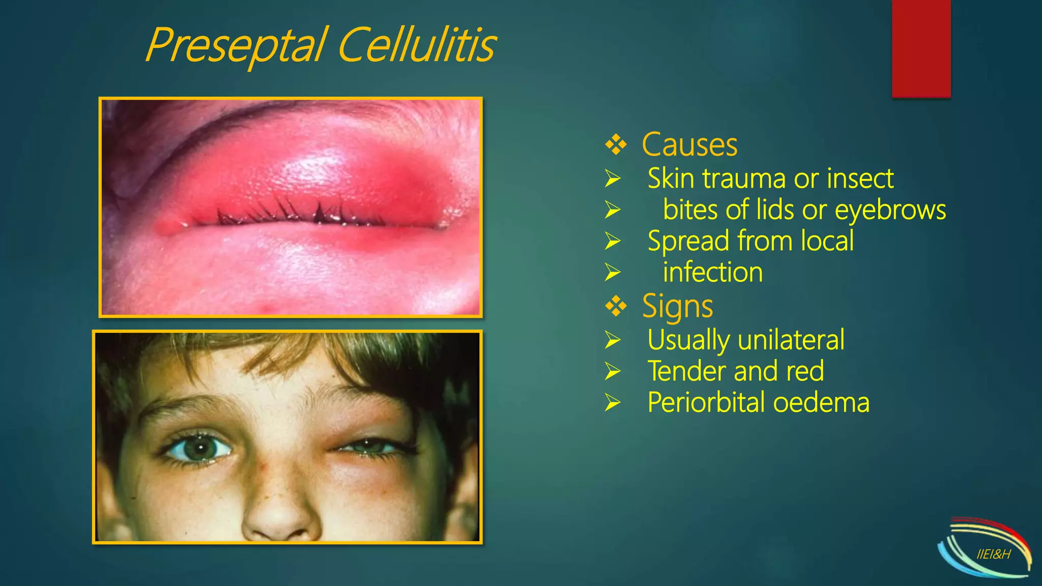 Disorders of eyelids | PPTX