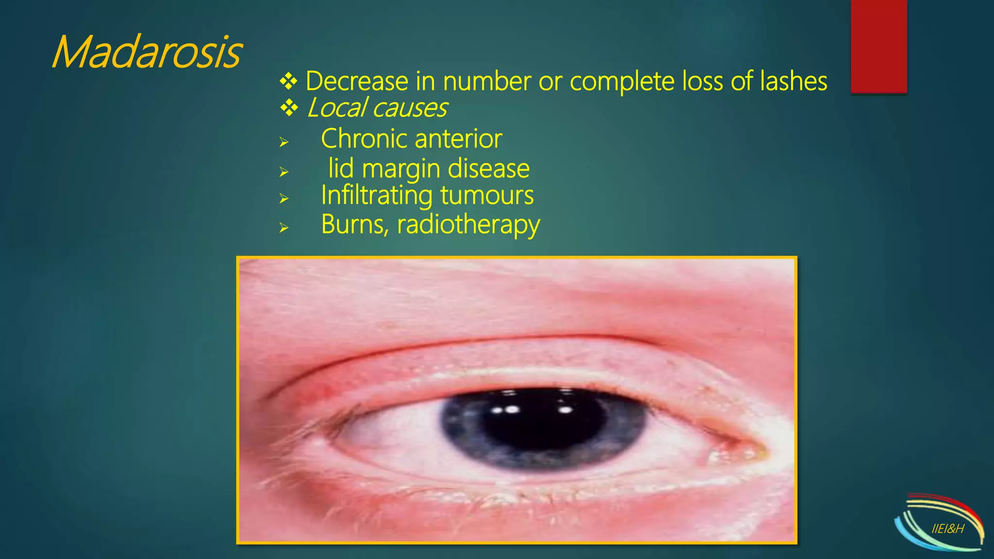 Disorders of eyelids | PPTX