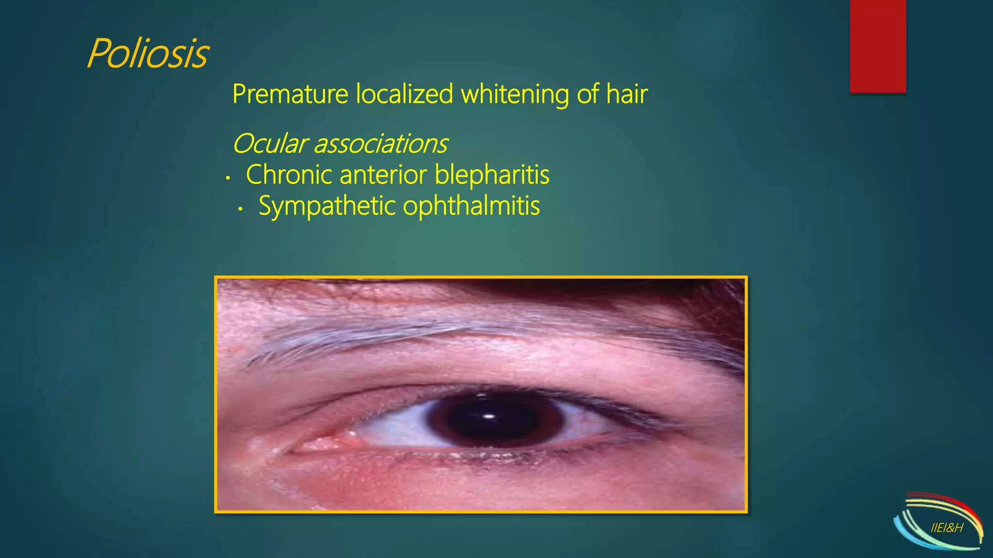 Disorders of eyelids | PPTX