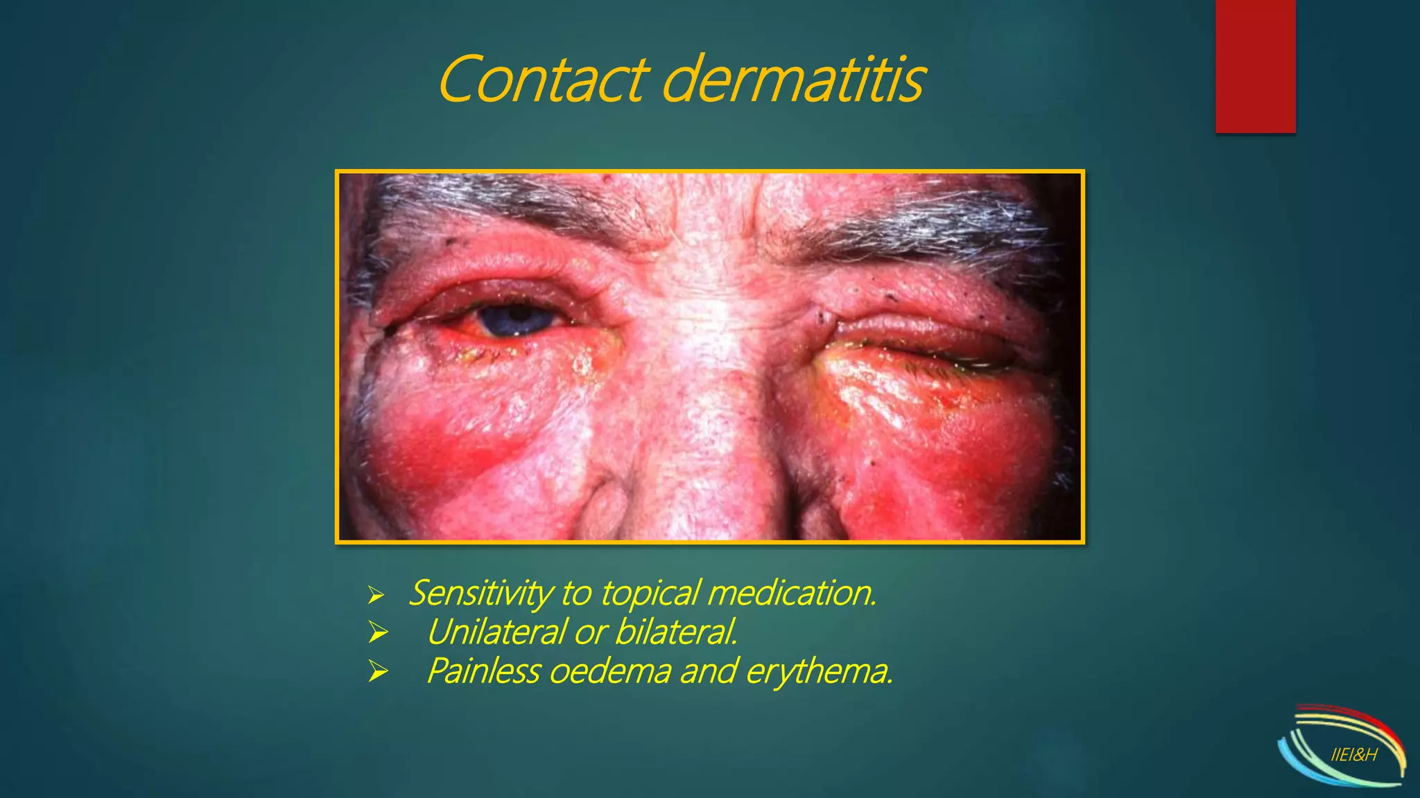 Disorders of eyelids | PPTX