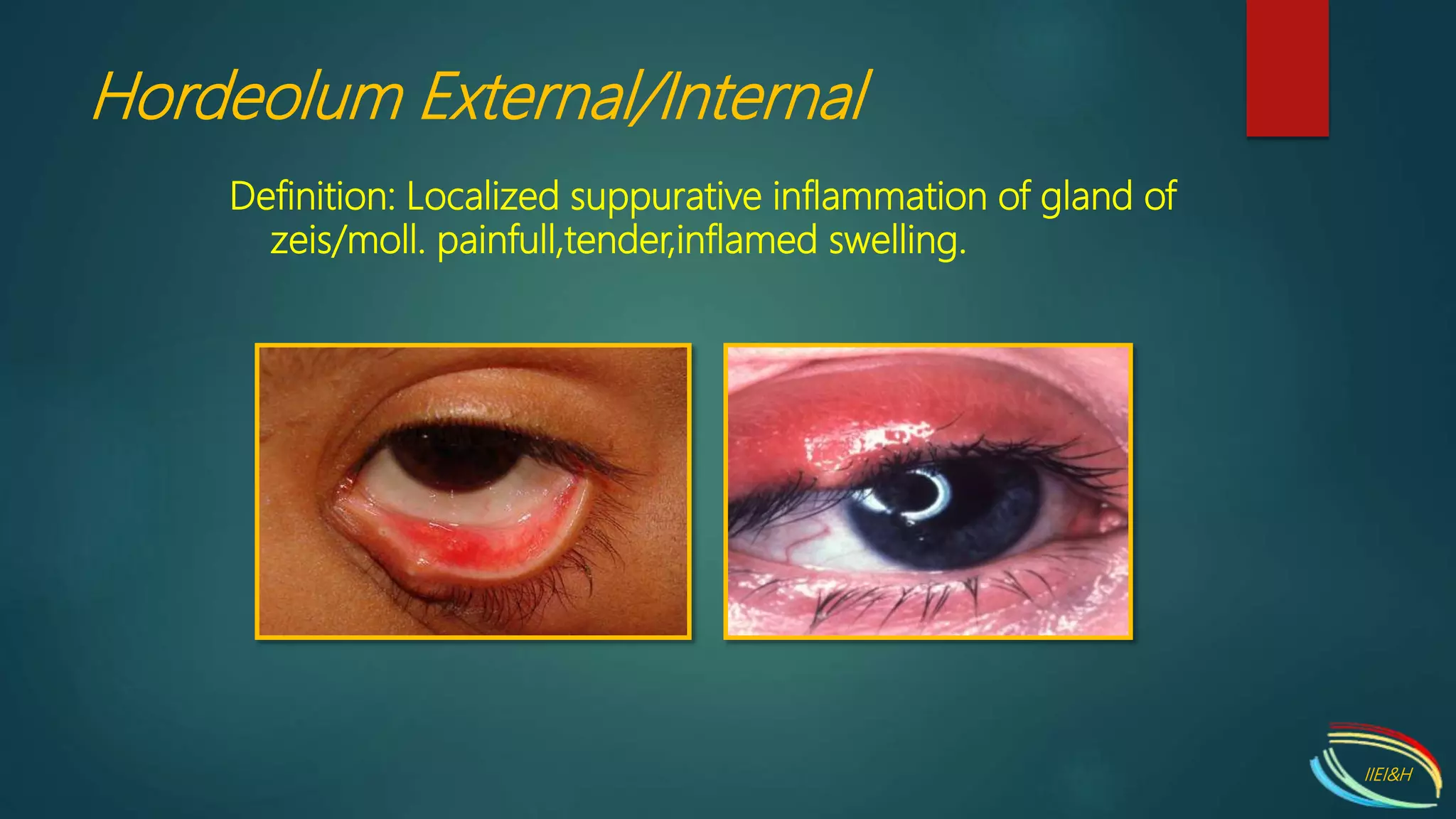 Disorders of eyelids | PPTX