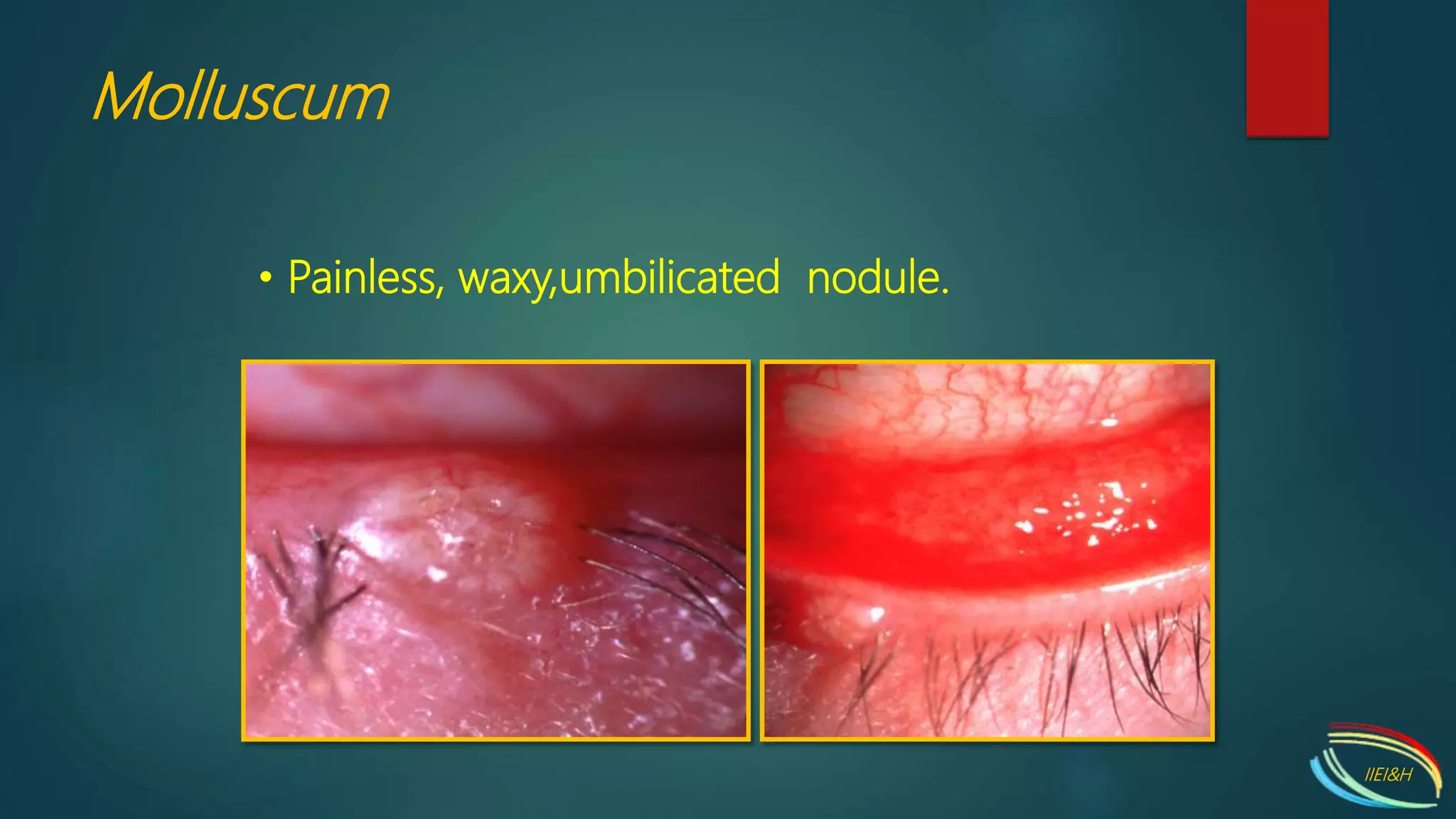 Disorders of eyelids | PPTX