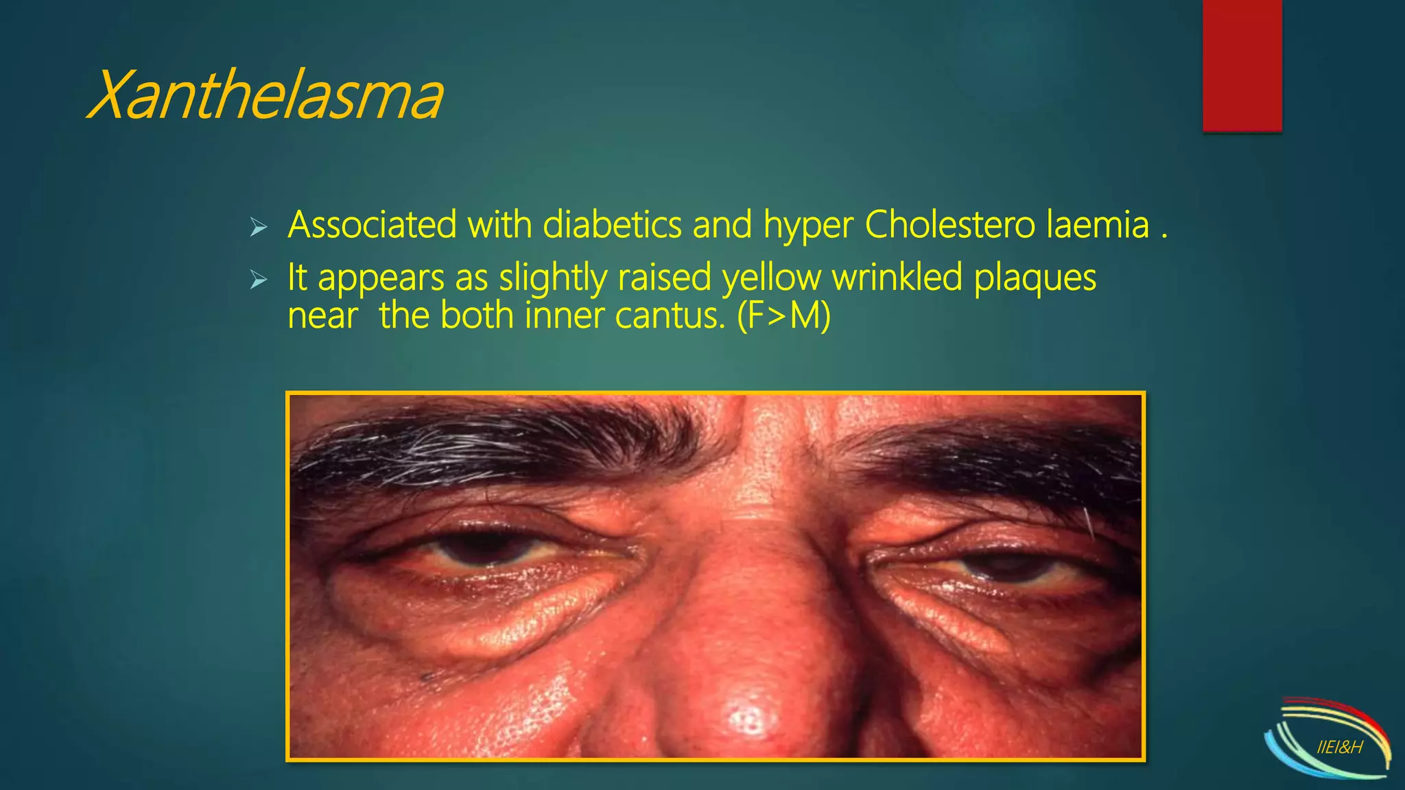 Disorders of eyelids | PPTX