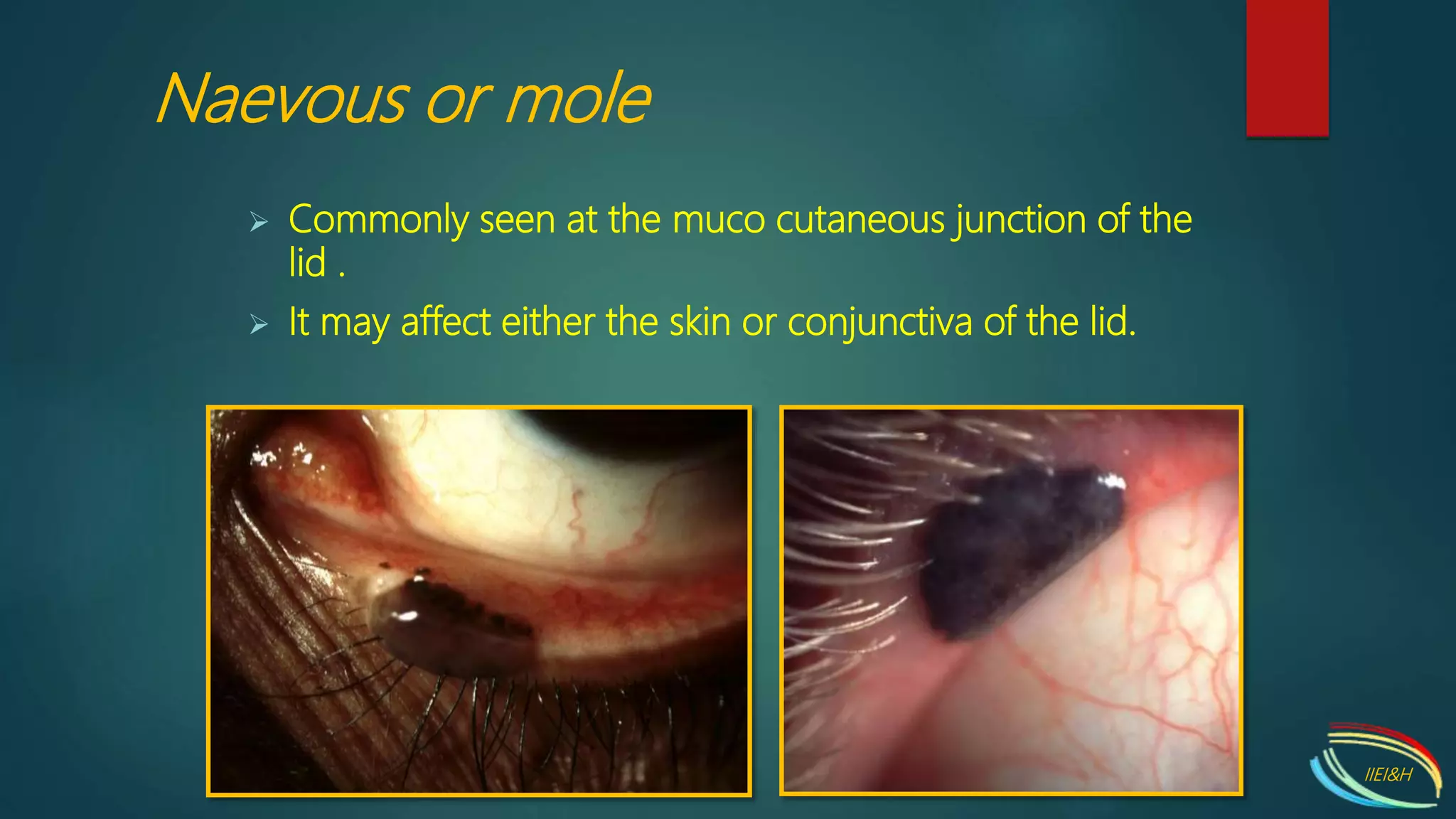 Disorders of eyelids | PPTX
