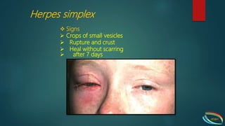 Disorders of eyelids | PPTX