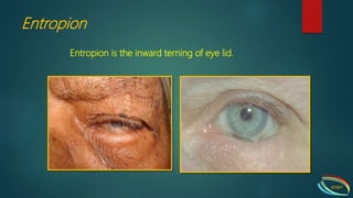 Disorders of eyelids | PPTX