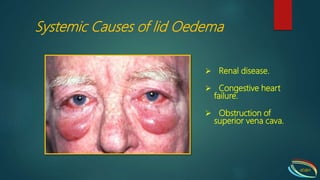 Disorders of eyelids | PPTX