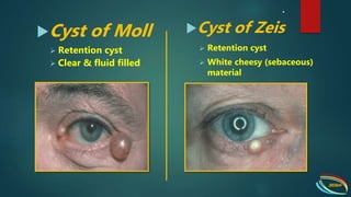 Disorders of eyelids | PPTX