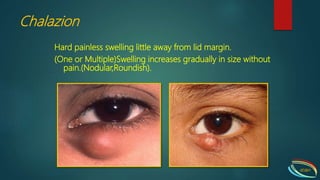 Eyelid Diseases