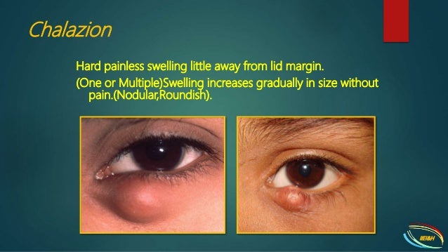 Disorders of eyelids
