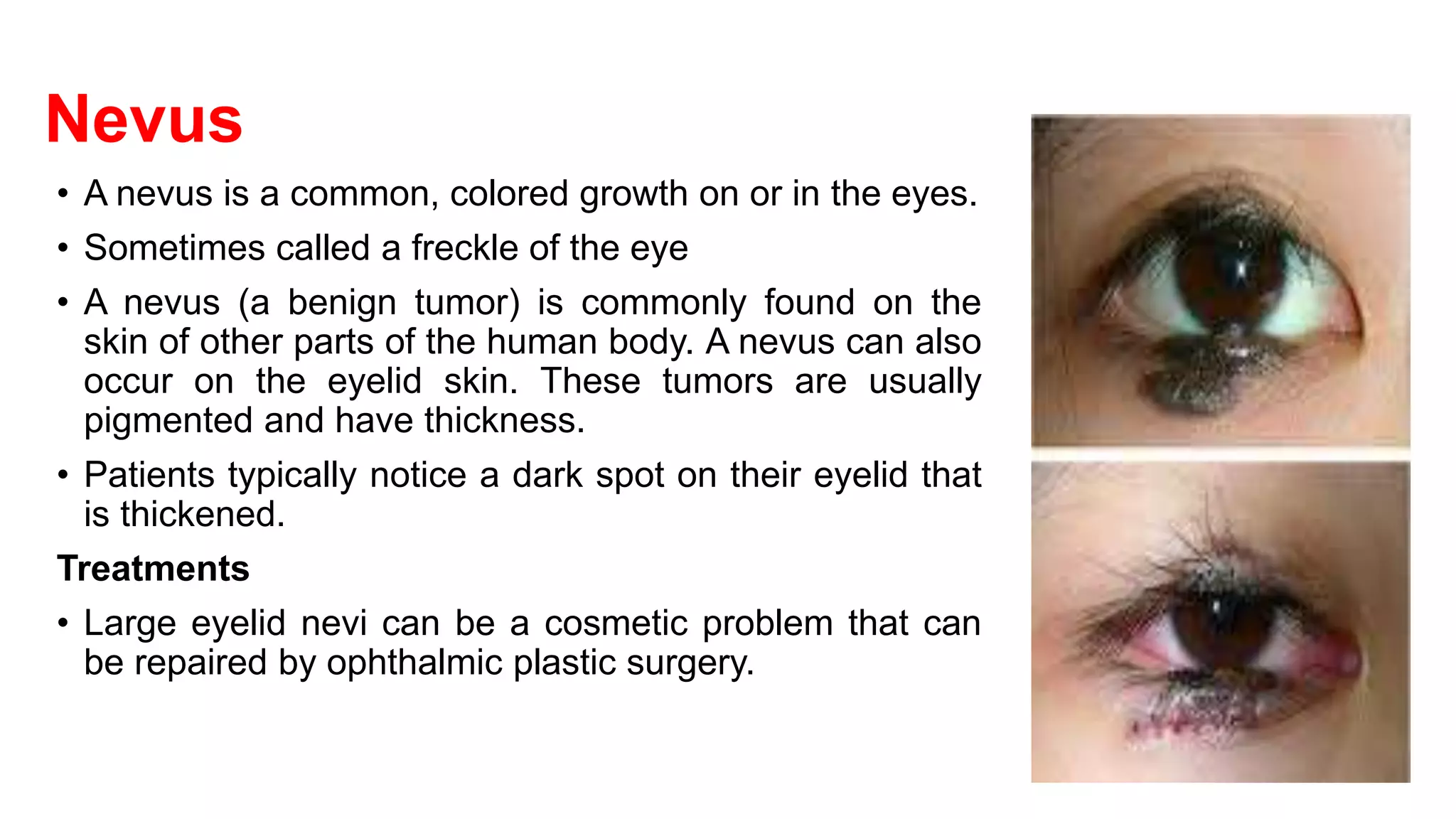 Eyelid disorders | PPTX